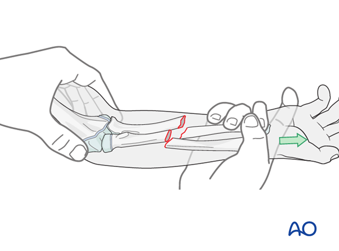 Closed reduction; cast fixation with/without wedging for Both bones ...