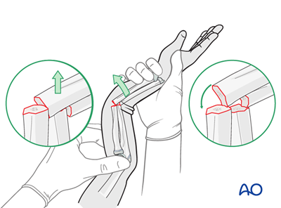 Closed reduction; cast fixation with/without wedging for Both bones ...