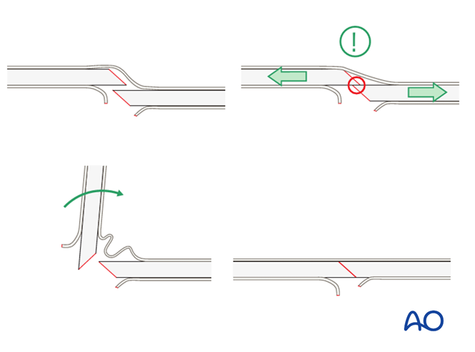 Closed reduction; cast fixation with/without wedging for Both bones ...