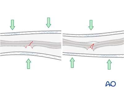 Closed reduction; cast fixation with/without wedging for Both bones ...