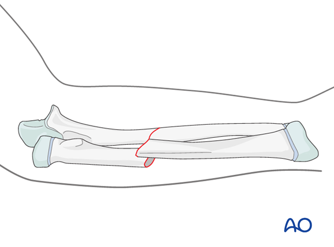 Closed reduction; cast fixation with/without wedging for Both bones ...