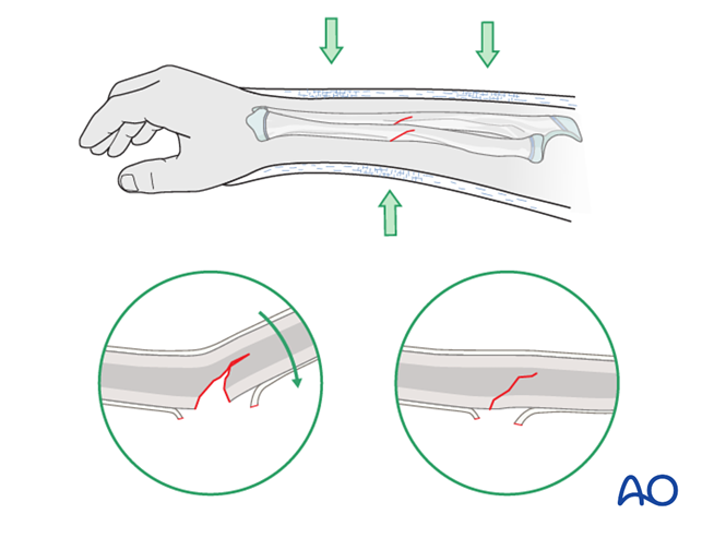 Closed reduction; cast fixation with/without wedging for Both bones ...