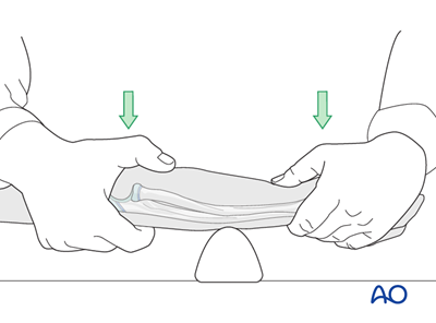Closed reduction; cast fixation with/without wedging for Both bones ...