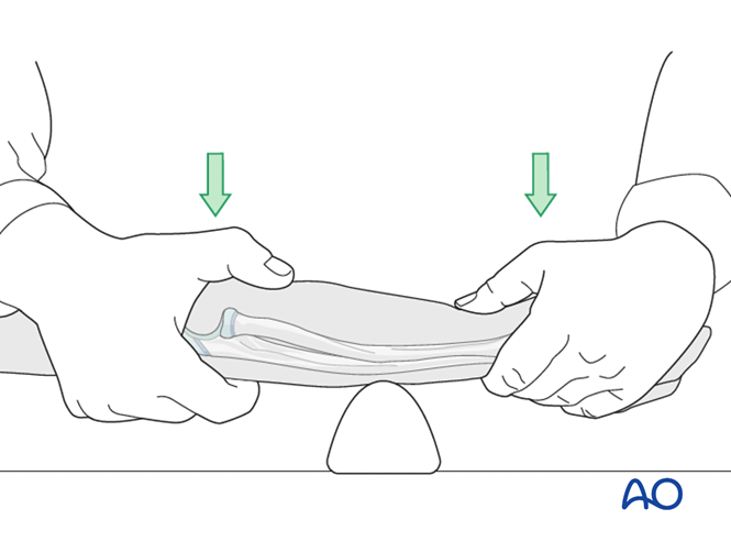 Closed reduction; cast fixation with/without wedging for Both bones ...