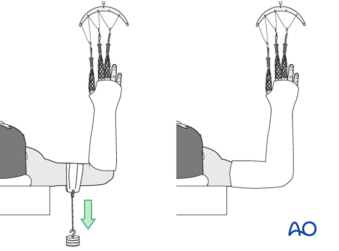 Closed reduction; cast fixation with/without wedging for Both bones ...