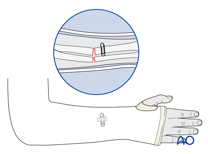 Closed reduction; cast fixation with/without wedging for Both bones ...