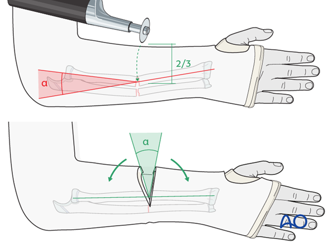 Closed reduction; cast fixation with/without wedging for Both bones ...