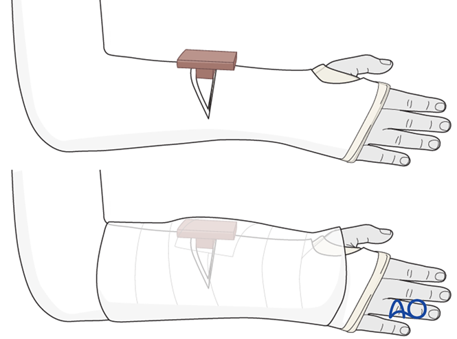 Closed reduction; cast fixation with/without wedging for Both bones ...