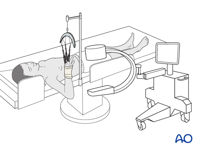 Closed reduction; cast or splint fixation for Ulna, complete transverse ...