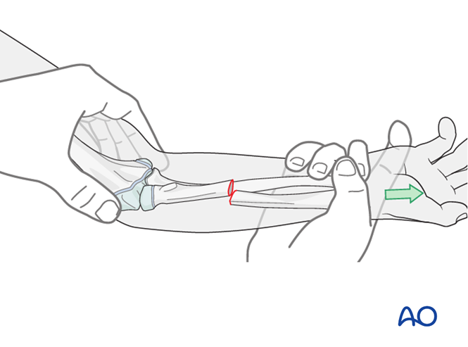 Closed reduction; cast or splint fixation for Radius, complete ...