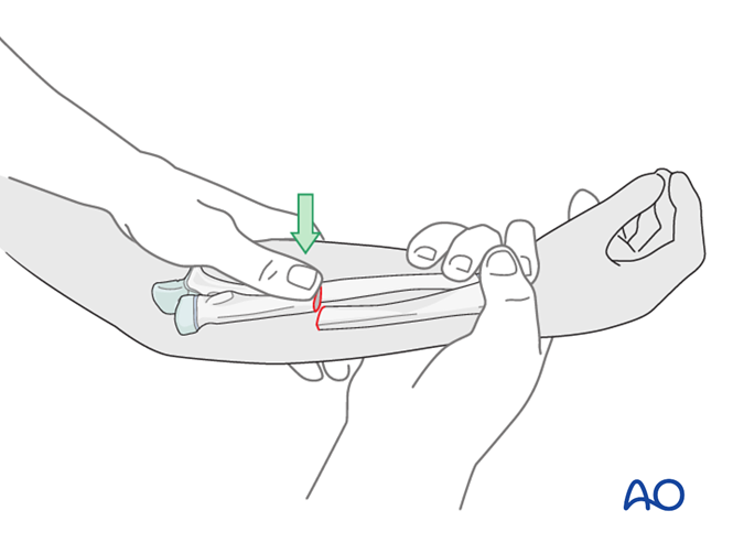 Closed reduction; cast or splint fixation for Radius, complete ...