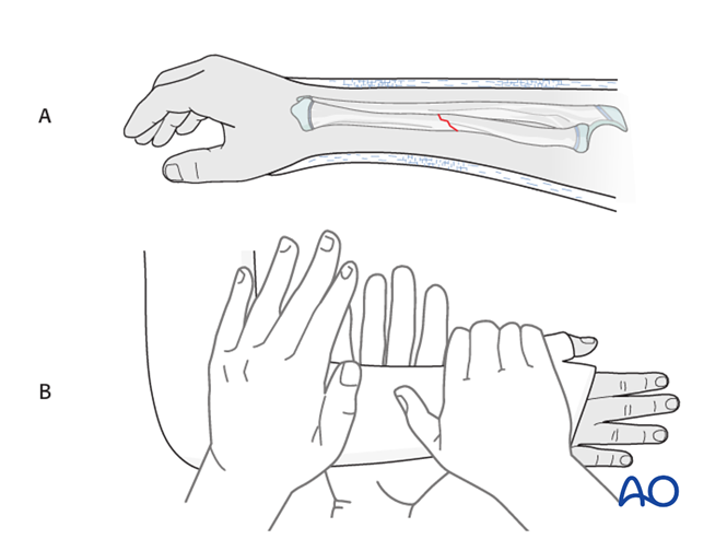 Closed reduction; cast or splint fixation for Radius, complete oblique ...