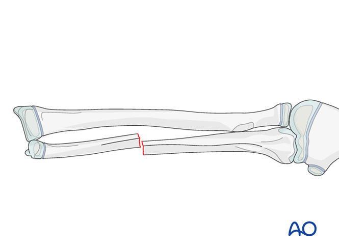 Closed reduction; cast or splint fixation for Ulna, complete transverse ...