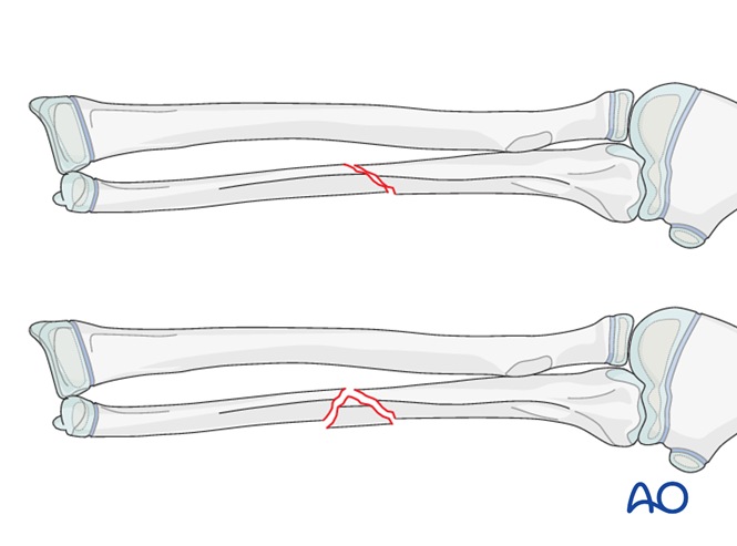 Closed reduction; cast or splint fixation for Ulna, complete oblique or ...