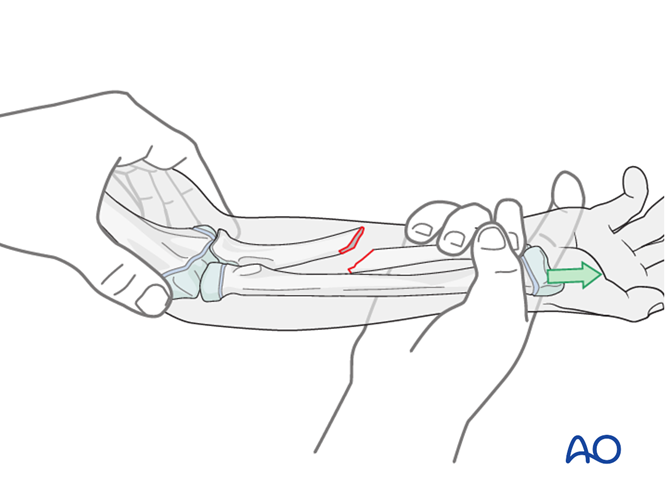Closed reduction; cast or splint fixation for Ulna, complete oblique or ...