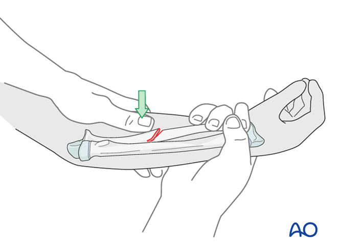 Closed reduction; cast or splint fixation for Ulna, complete oblique or ...