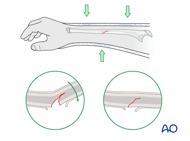 Closed reduction; cast or splint fixation for Ulna, greenstick