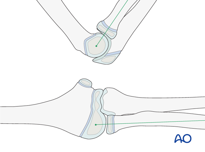 Closed reduction; cast fixation for Monteggia lesion