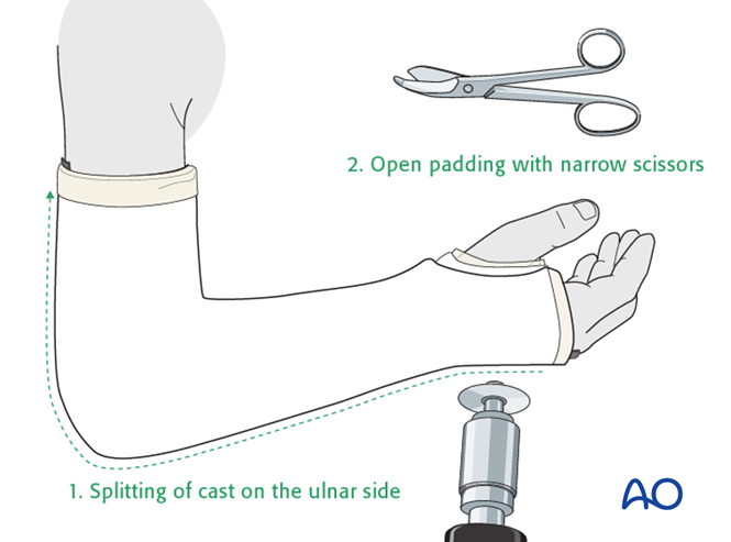 Closed reduction; cast fixation for Monteggia lesion