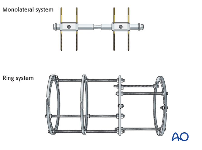 External fixation for Both bones, combination of radial and ulnar fracture