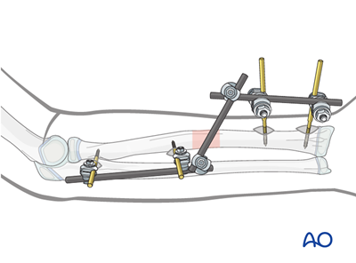 External fixation for Radius, complete oblique or spiral