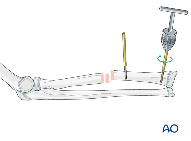 External fixation for Radius, complete transverse, simple