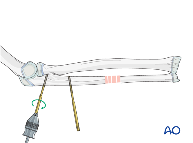 External fixation for Ulna, complete oblique or spiral