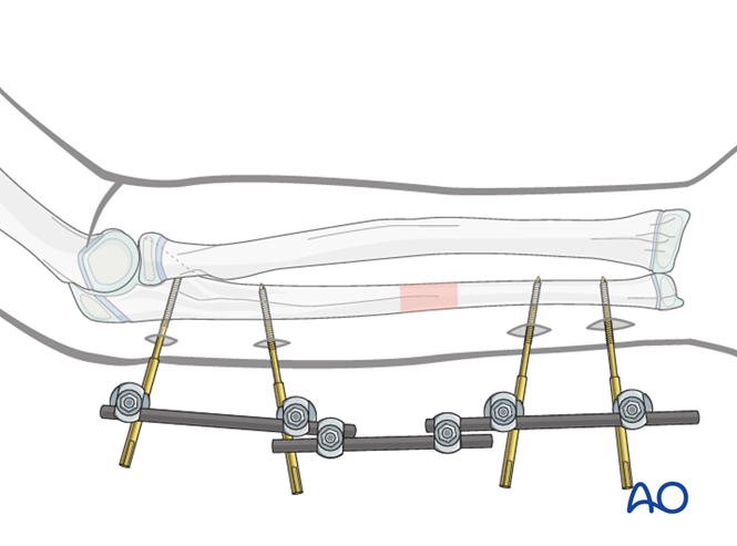 External fixation for Ulna, complete oblique or spiral