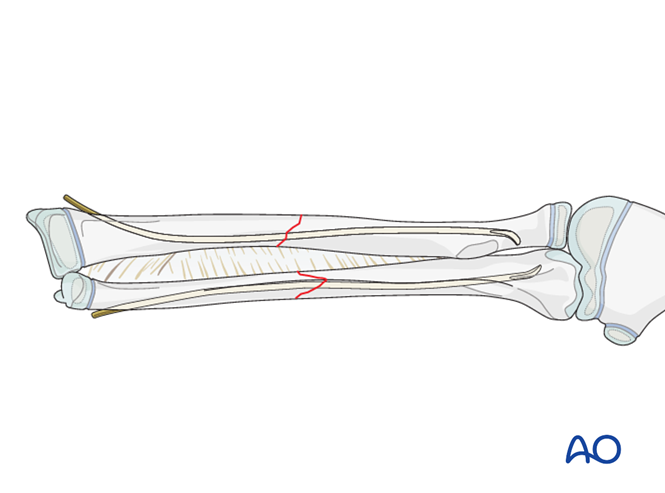 ESIN for Both bones, combination of radial and ulnar fracture