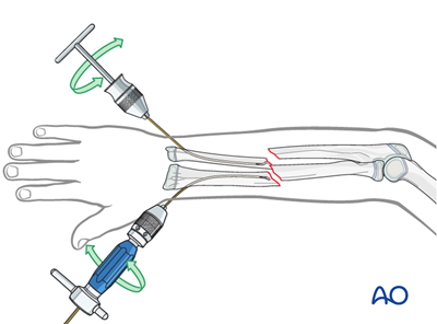 ESIN for Both bones, combination of radial and ulnar fracture