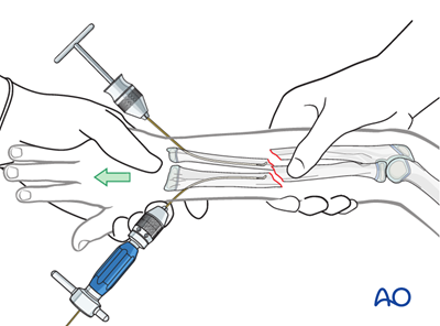 ESIN for Both bones, combination of radial and ulnar fracture