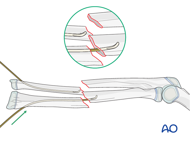 ESIN for Both bones, combination of radial and ulnar fracture