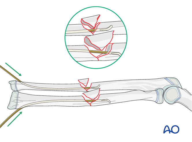 ESIN for Both bones, combination of radial and ulnar fracture