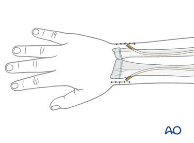 ESIN for Both bones, combination of radial and ulnar fracture