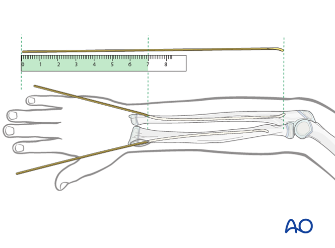 ESIN for Both bones, combination of radial and ulnar fracture