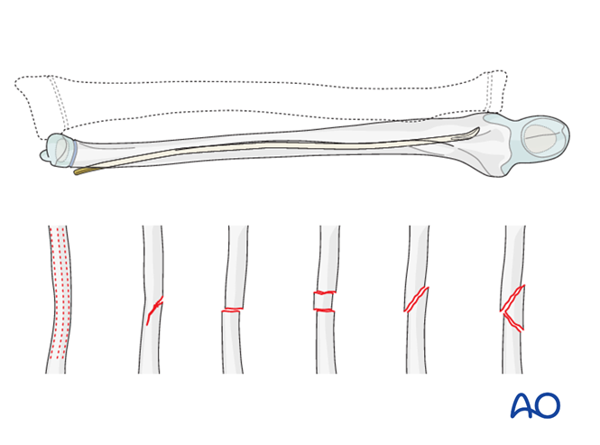 ESIN for Monteggia lesion