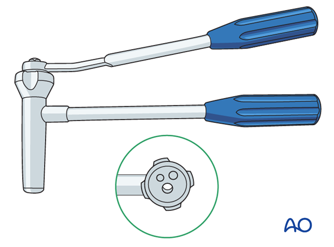 ESIN for Both bones, combination of radial and ulnar fracture