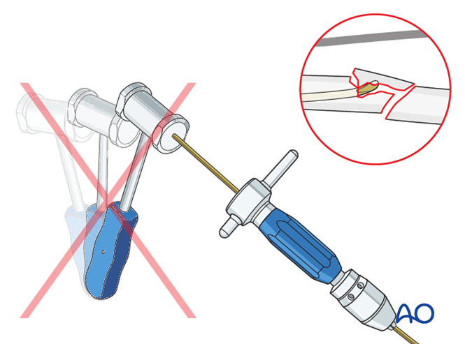 ESIN for Both bones, combination of radial and ulnar fracture