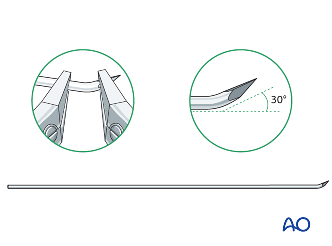 ESIN for Both bones, combination of radial and ulnar fracture