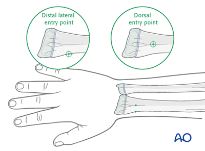 Radius, bowing: ESIN
