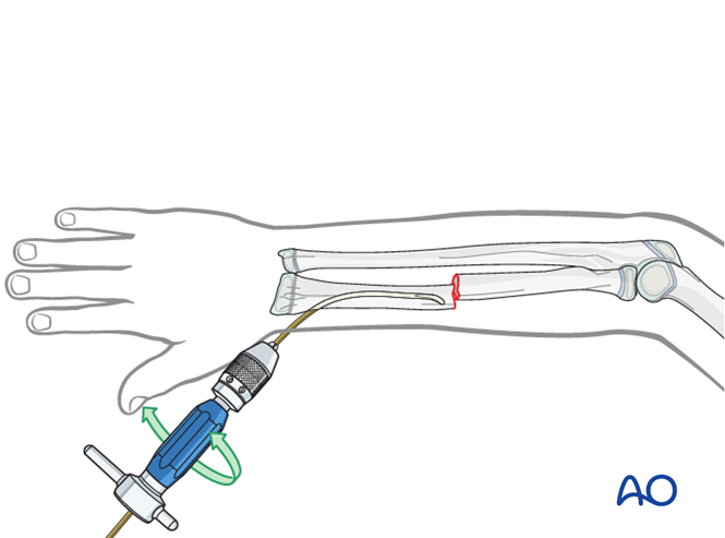 ESIN for Radius, complete transverse, simple