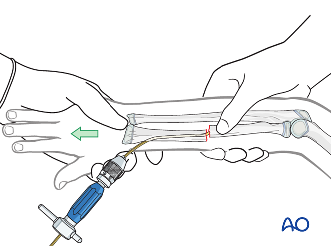 ESIN for Radius, complete transverse, simple
