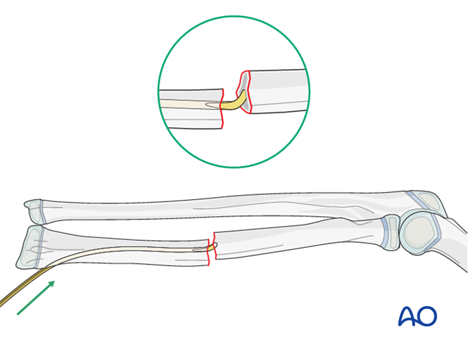 ESIN for Radius, complete transverse, simple
