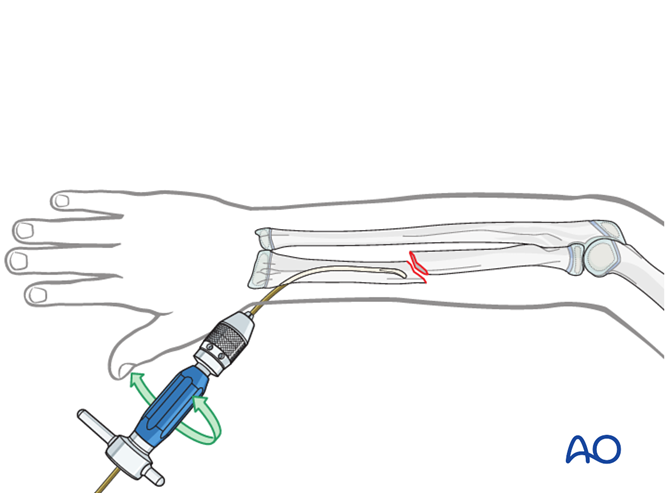 ESIN for Radius, complete oblique or spiral
