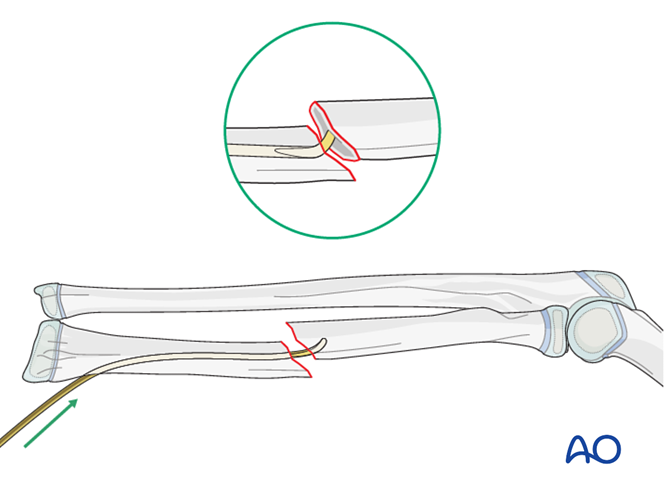 ESIN for Radius, complete oblique or spiral
