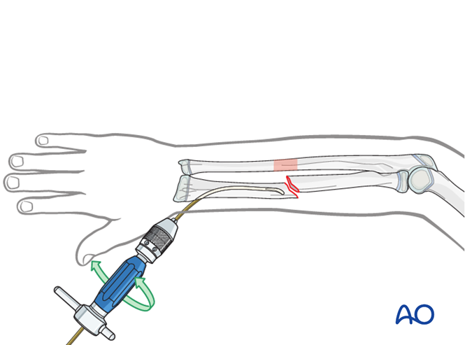 Radius, complete fracture: ESIN