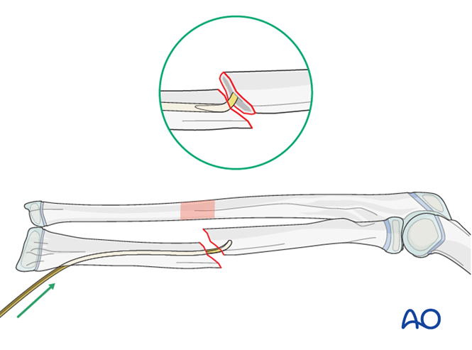 Radius, complete fracture: ESIN