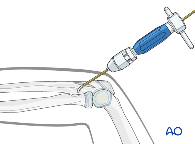 ESIN for Ulna, greenstick