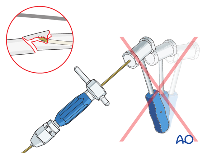 ESIN for Ulna, complete transverse, multifragmentary