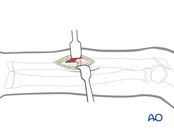 ESIN for Both bones, combination of radial and ulnar fracture